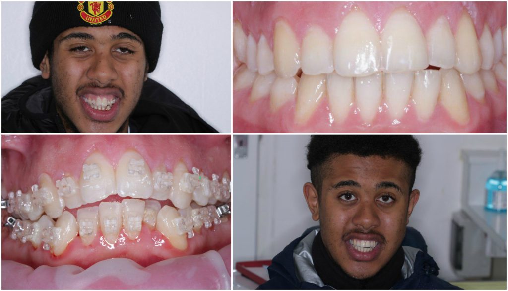 SIX MONTH SMILE - Green Lane Dental Centre