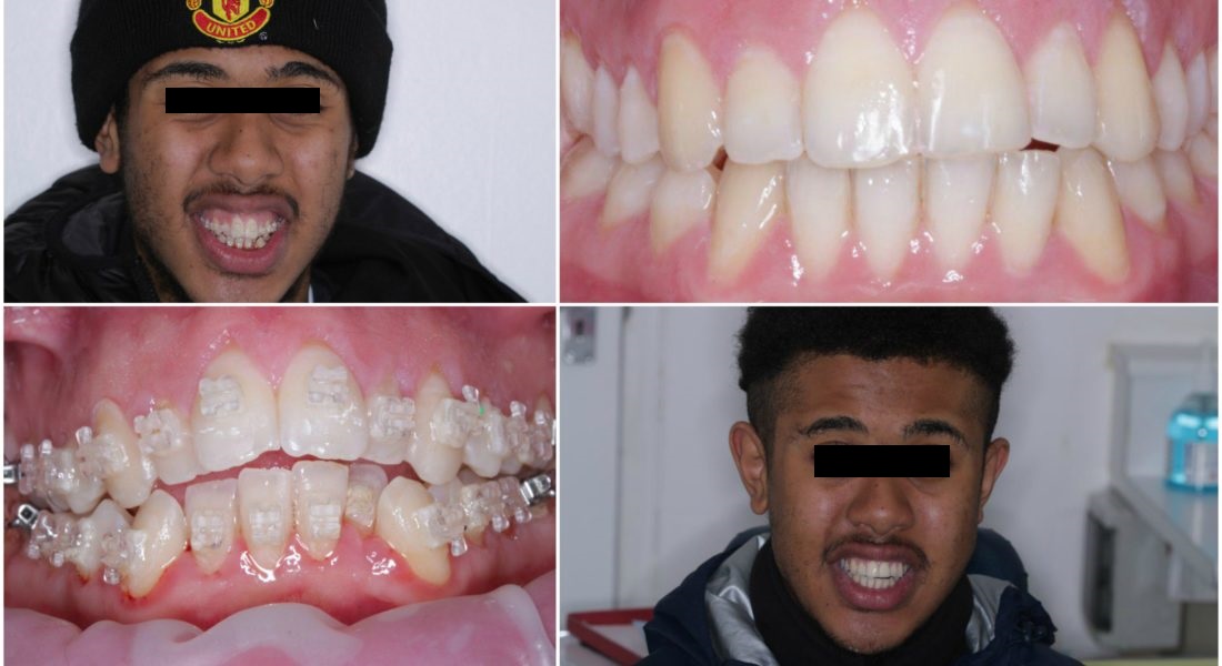 SIX-MONTH-SMILE-1100x600 - Green Lane Dental Centre