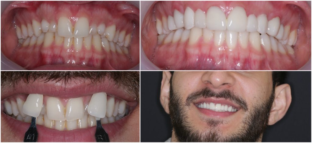Porcelain Veneers Penge, South East London | Book Free Consultation!