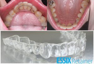 essix retainer - Green lane Dental Centre