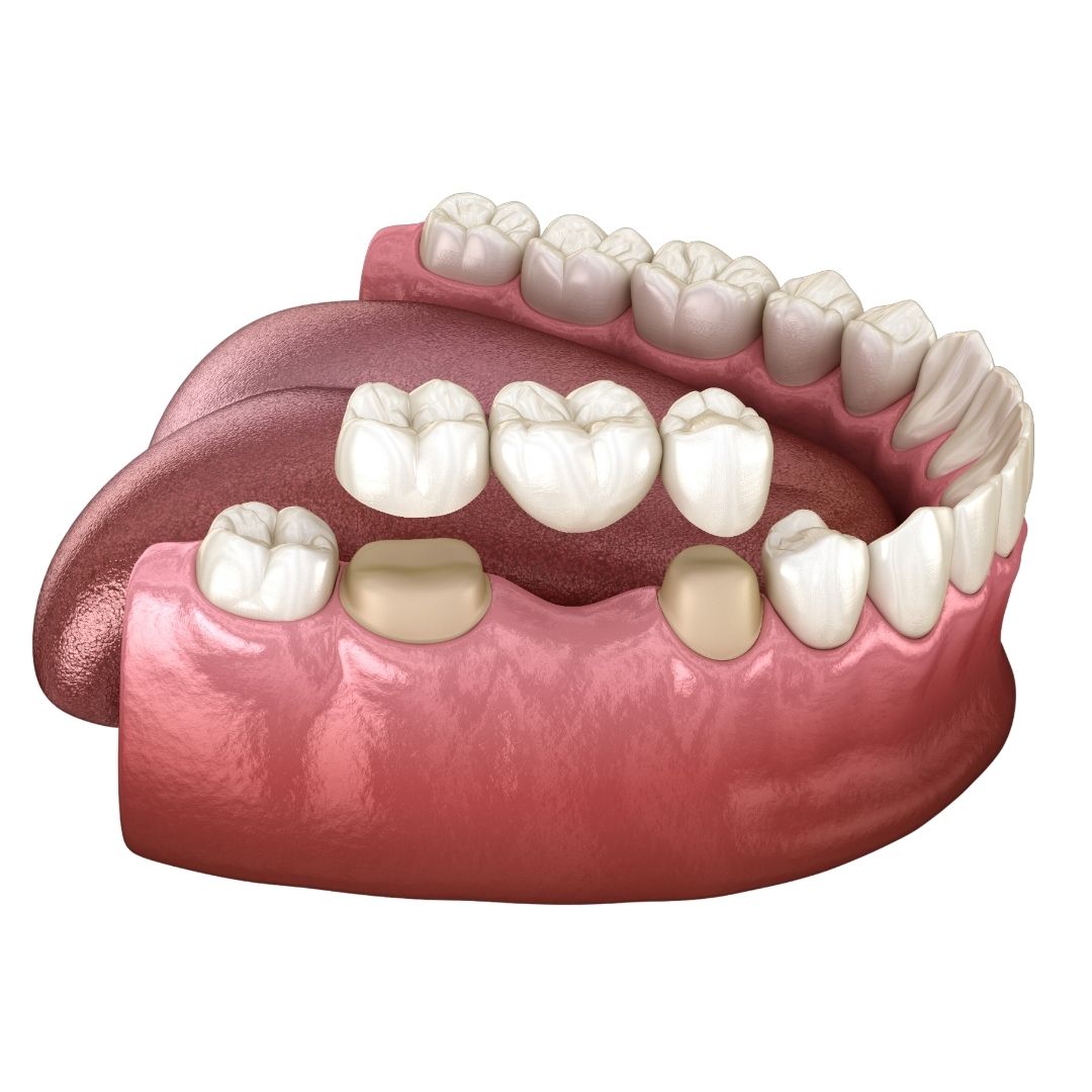 Dental Bridges in Penge, South East London | NHS & Private Dentist SE20