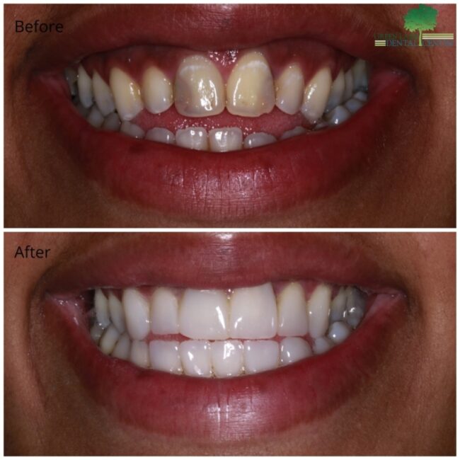 Composite Bonding - Smile Gallery - Green Lane Dental Centre