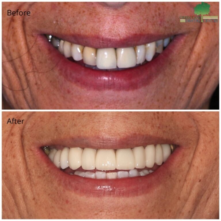 Dental Crown - Smile Gallery - Green Lane Dental Centre