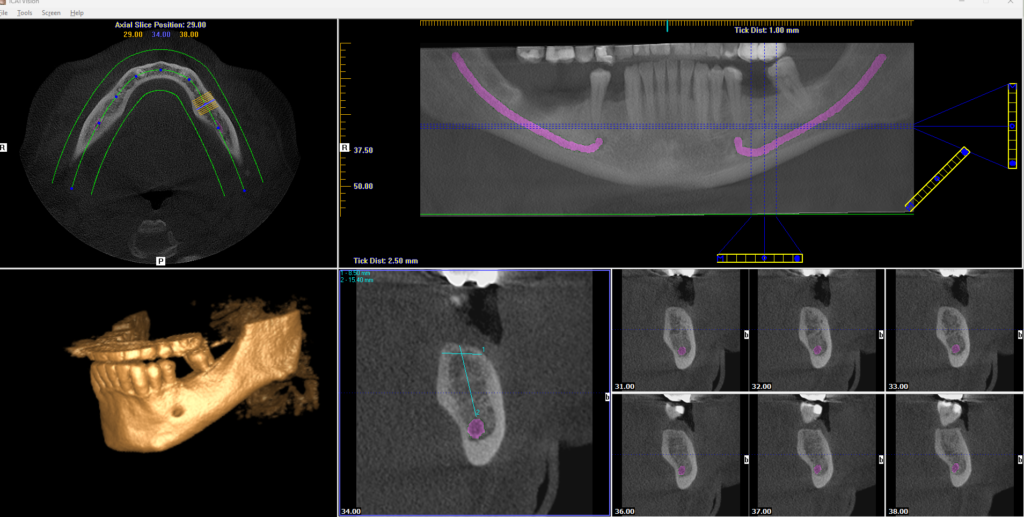 Why 3D Xray ( Cbct scan) is necessary before implant placement? - Green ...