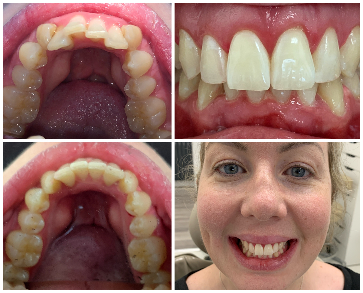 Invisalign - Smile Gallery - Green Lane Dental Centre