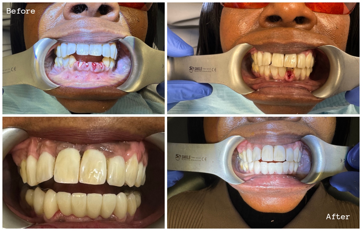 Dental Bridges - Smile Gallery - Green Lane Dental Centre