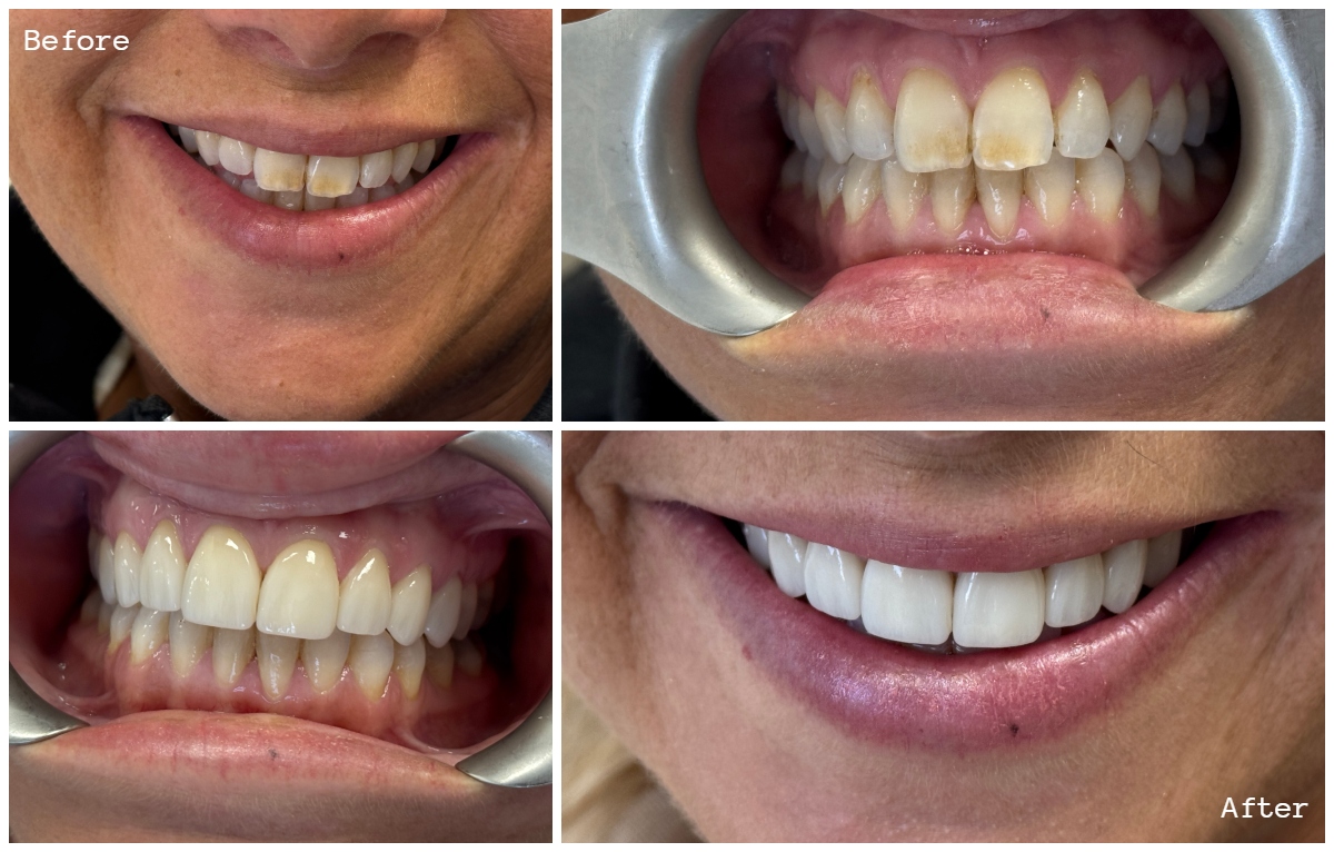 Dental Veneers - Smile Gallery - Green Lane Dental Centre